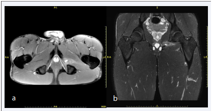 A Case of Ischial Bursitis Occurring in Obturator Externus Muscle ...