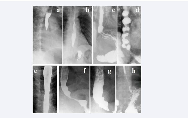 Jackhammer Esophagus - Symptom or Diagnosis? Review