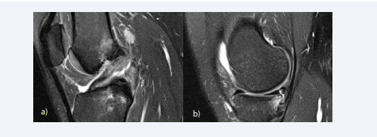 Anterior Cruciate Ligament Injuries: MR Imaging Diagnosis with Surgical Implications