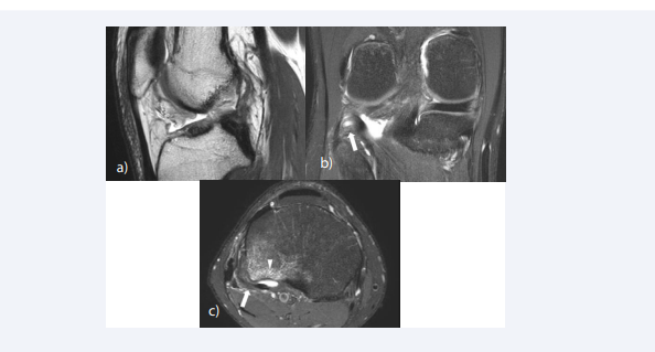 Anterior Cruciate Ligament Injuries: MR Imaging Diagnosis with Surgical ...