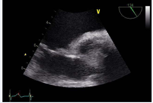 Corynebacterium Jeikeium Endocarditis in a Hemodialysis Patient with an ...