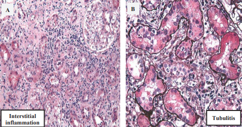 Acute Tubulo-Interstitial Nephritis due to Proton-Pump Inhibitors