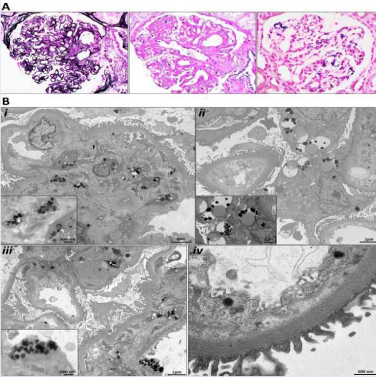 Renal Hemosiderosis with Bevacizumab Induced Thrombotic Microangiopathy ...