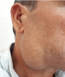 Huge Branchial Parotid Cyst: A Case Report and Review of the Literature