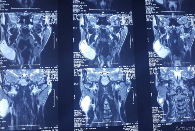Huge Branchial Parotid Cyst: A Case Report and Review of the Literature