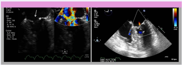 Superior Vena Cava Syndrome with Massive Thrombosis after Aortic Valve ...
