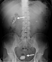 Spontaneous Fragmentation of Indwelling Ureteral Stent after Three Decades