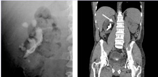 Spontaneous Fragmentation of Indwelling Ureteral Stent after Three Decades