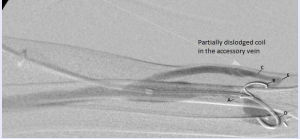 Management of a Partially Dislodged Embolization Coil in an ...