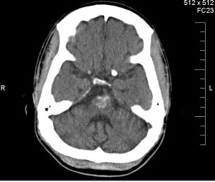 A Rare Case of CNS Mineralization in End Stage Renal Disease