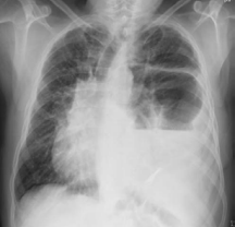 Respiratory Failure Secondary to Long-Standing Diaphragmatic Hernia ...