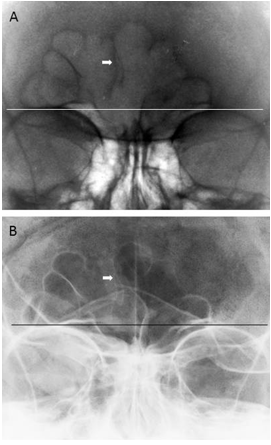 Identification of a Charred Body through the Radiographic Morphology of ...