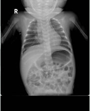Respiratory Distress as an Isolated Manifestation of Status Epilepticus
