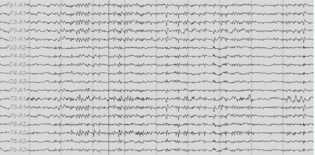 Respiratory Distress as an Isolated Manifestation of Status Epilepticus
