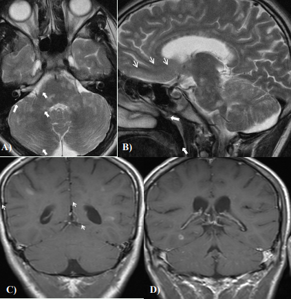 Bilateral Hemifacial Spasms as a Presenting Manifestation of Multiple ...