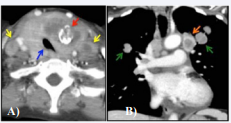 Diffuse Sclerosing Variant of Papillary Thyroid Carcinoma Presenting ...