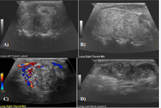 Diffuse Sclerosing Variant of Papillary Thyroid Carcinoma Presenting ...