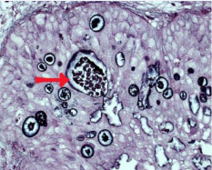 A Case of Rhinosporidiosis and Concomitant Inverted Papilloma - A ...