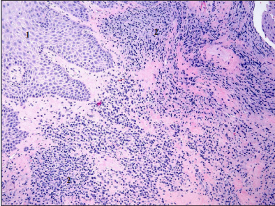 Comparative Morphology of Chronic and Rapidly Progressive Periodontitis
