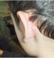 Treatment of Keloid Scars by Botulinum Toxin