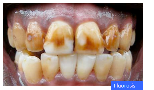 Fluorides in Dental Tissues: Caries Prevention and Fluorosis