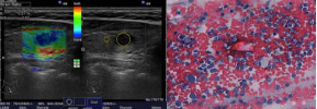 Combined Thyroid Imaging Report and Data System Ti-Rads and Ultrasound ...