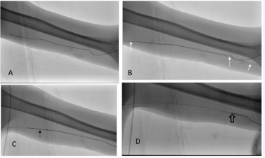 Freeing a stuck Central Venous Catheter- An Enzymatic Approach