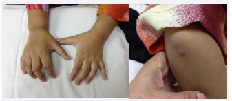 Subcutaneous Nodules and Delayed Diagnosis in Acute Rheumatic Fever: A ...